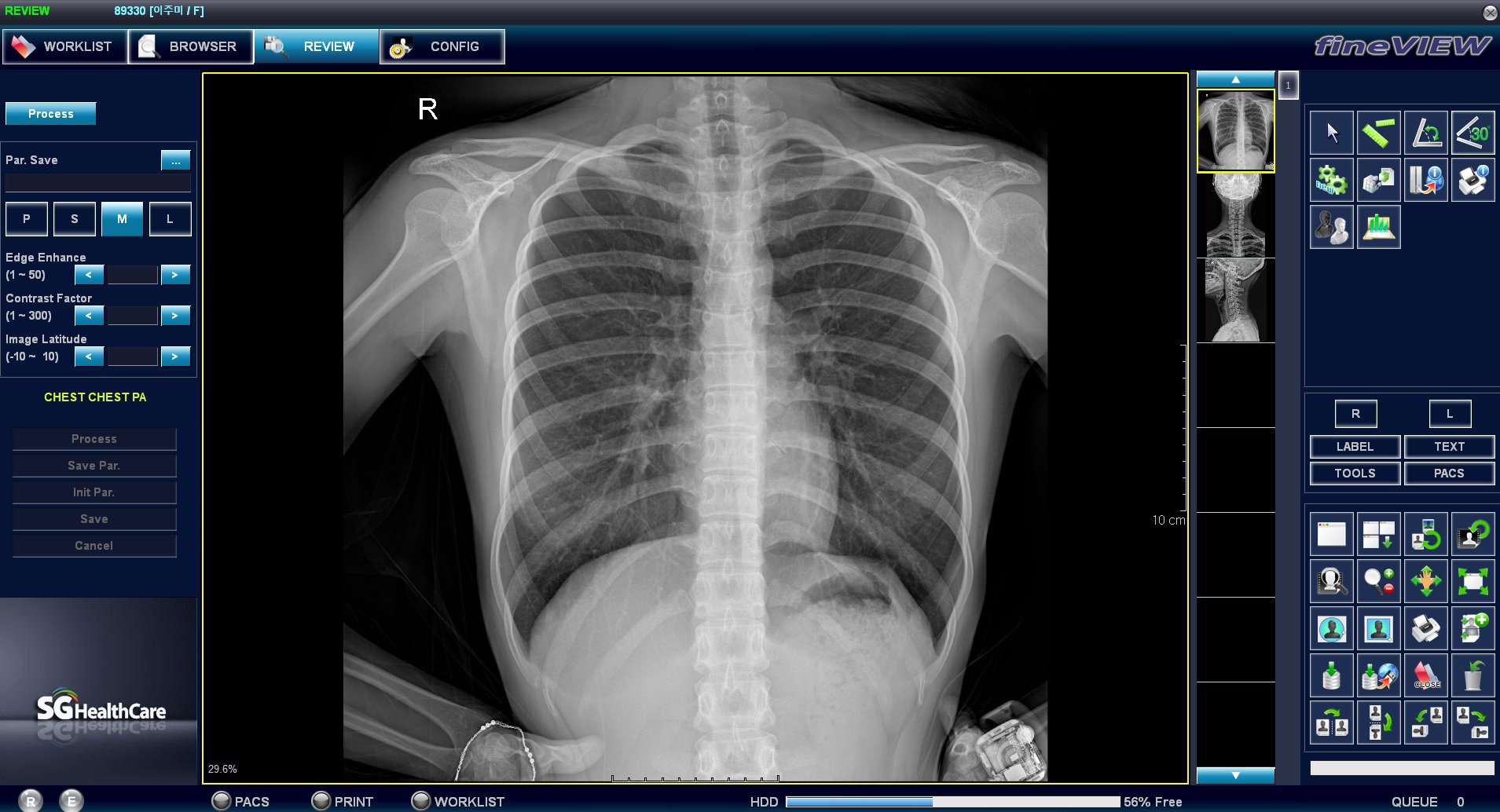 ¿Qué es la digitalización de placas de Rayos-X?